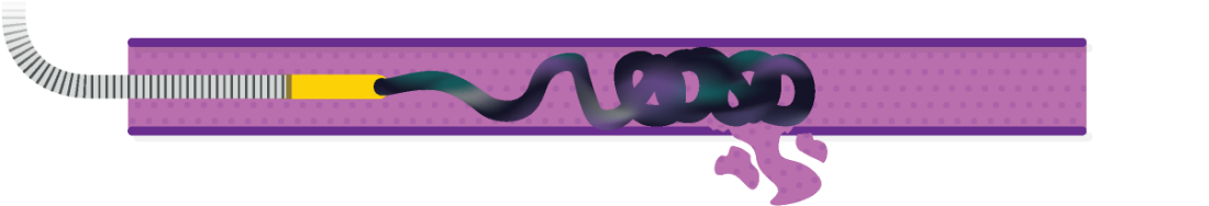 How to use Obsidio™ Conformable Embolic - Boston Scientific