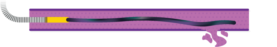 How to use Obsidio™ Conformable Embolic - Boston Scientific