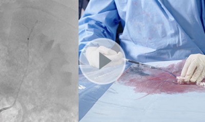 Resources - Obsidio™ Conformable Embolic - Boston Scientific