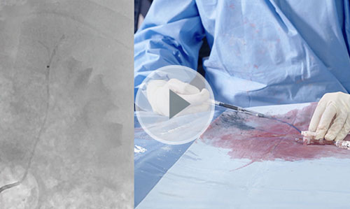 Resources - Obsidio™ Conformable Embolic - Boston Scientific