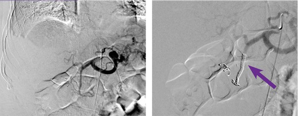 Gastroduodenal artery (GDA) embolization Obsidio™ Case Study - Boston ...