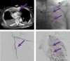 Internal mammary artery embolization Obsidio™ Embolic Case Study ...