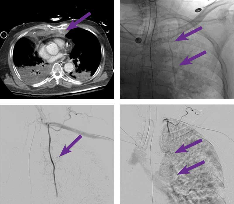 Internal mammary artery embolization Obsidio™ Embolic Case Study - Boston Scientific