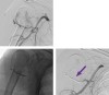 Pre-operative humerus lesion embolization – Obsidio™ Embolic Case ...