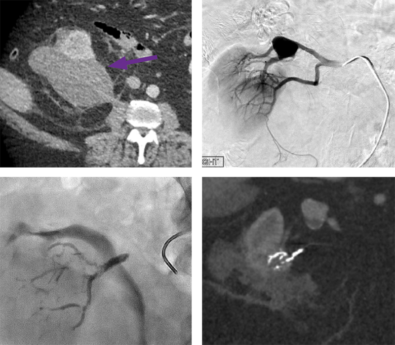 Renal mass embolization Obsidio™ Case Study - Boston Scientific