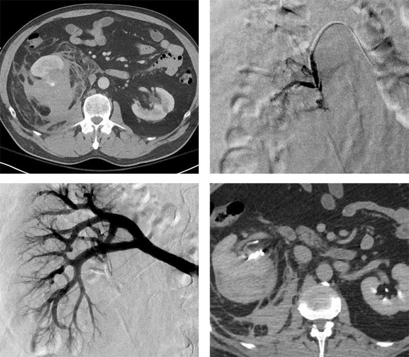 Renal pseudoneurysm embolization Obsidio™ Case Study - Boston Scientific