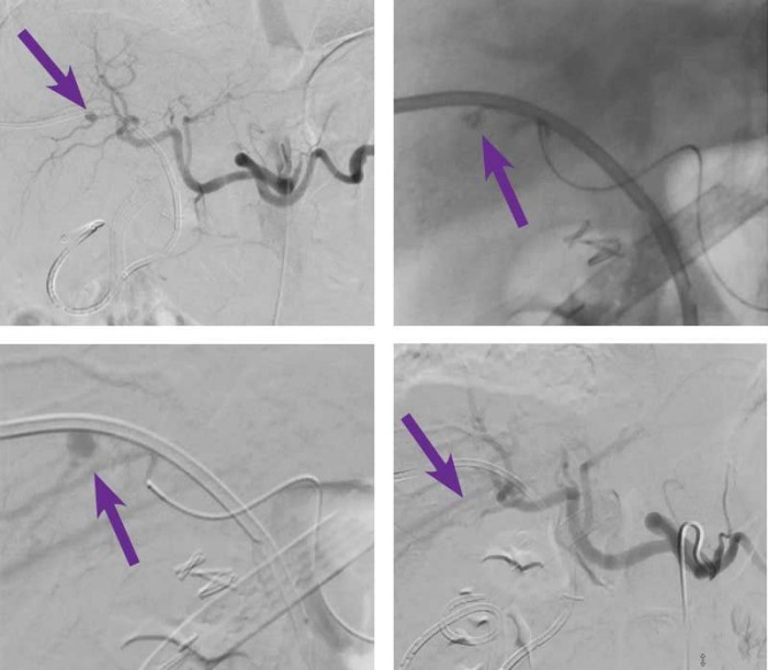 Hepatic artery pseudoaneurysm embolization Obsidio™ Embolic Case ...