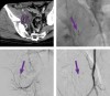 Internal iliac artery embolization – Obsidio™ Embolic Case - Boston ...