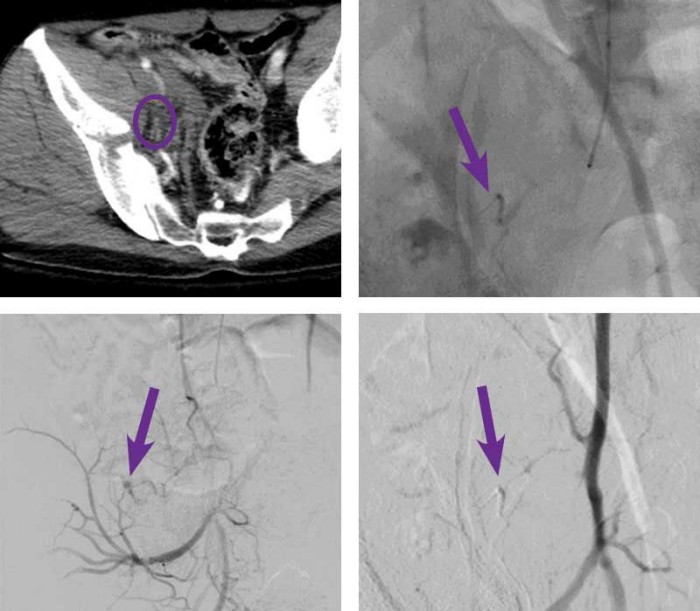 Internal iliac artery embolization – Obsidio™ Embolic Case - Boston ...