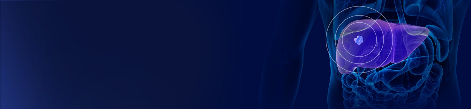 Therasphere™ Clinical Data for HCC & mCRC Patients - Boston Scientific