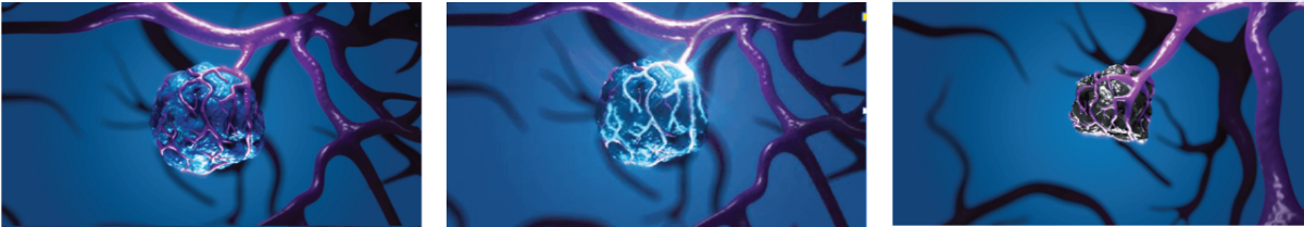 TheraSphere™ Referring Physicians Resources - Boston Scientific