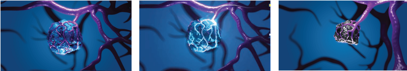 TheraSphere™ Referring Physicians Resources - Boston Scientific