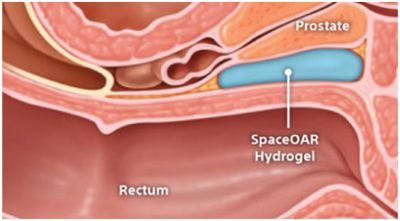 SpaceOAR™ Systems – Perirectal Spacers for Prostate Radiation Therapy - Boston Scientific