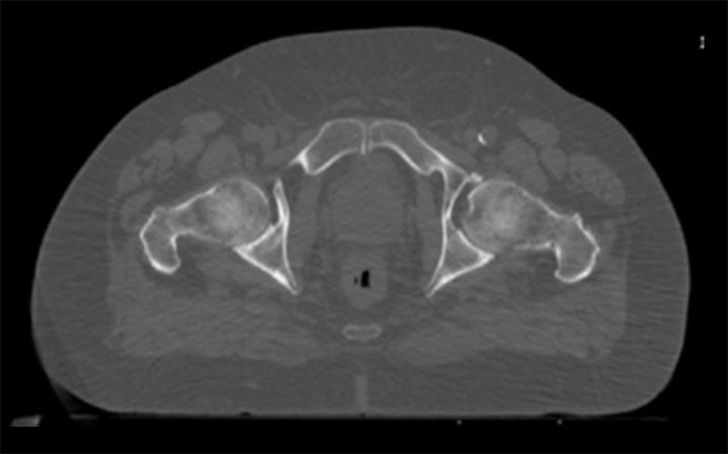 Frequently Asked Questions - SpaceOAR Hydrogel - Boston Scientific