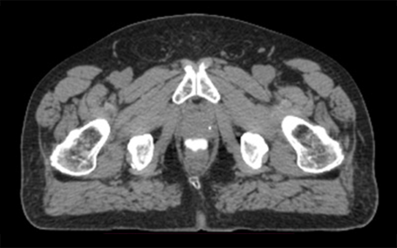 Frequently Asked Questions - SpaceOAR Hydrogel - Boston Scientific
