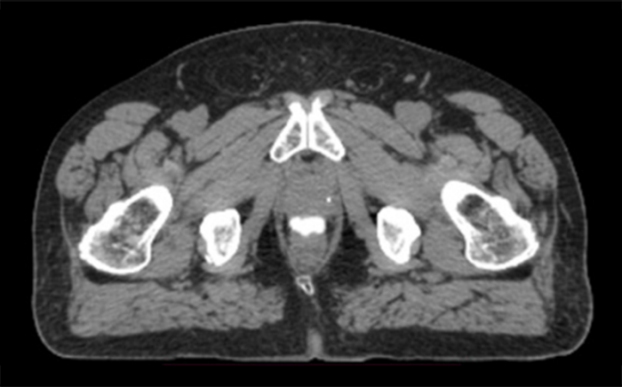 Frequently Asked Questions - SpaceOAR Hydrogel - Boston Scientific
