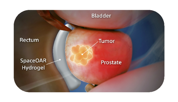 Product and Procedure – SpaceOAR Hydrogel - Boston Scientific
