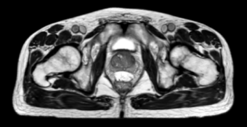 SpaceOAR Vue Hydrogel - Radiopaque Perirectal Spacer - Boston Scientific