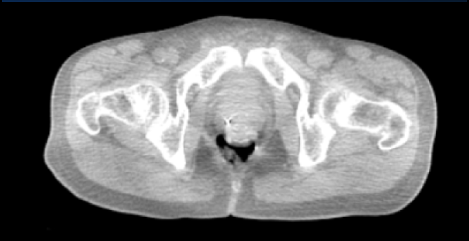 SpaceOAR Vue Hydrogel - Radiopaque Perirectal Spacer - Boston Scientific