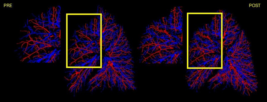 OPTALYSE 3D Study - EKOS Endovascular System - Boston Scientific