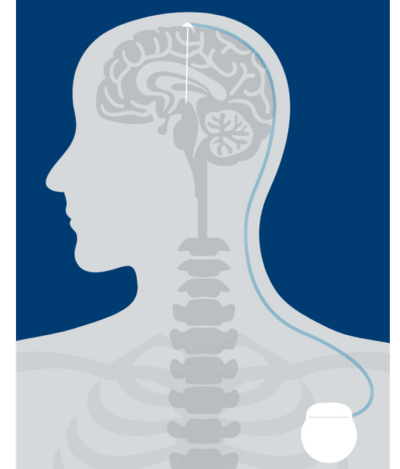 How Deep Brain Stimulation works - Boston Scientific