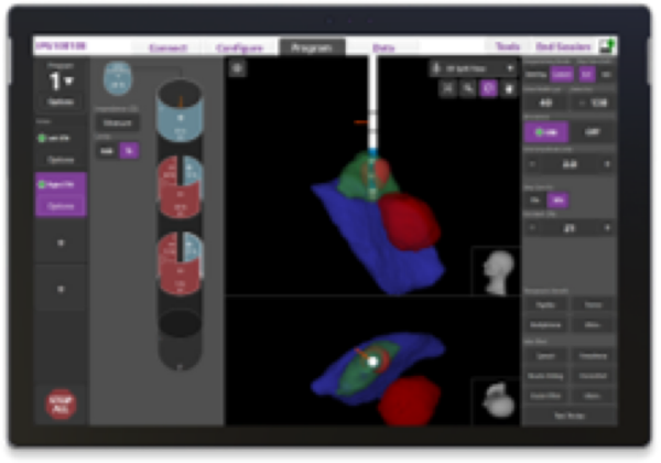 How Deep Brain Stimulation works - Boston Scientific