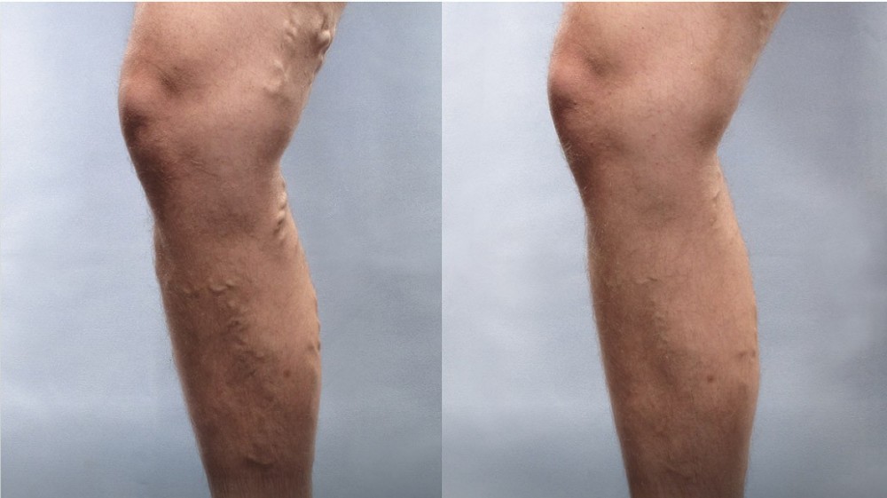 Varithena - Boston Scientific