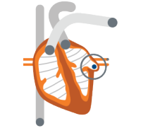 Atrial Fibrillation - AFib Symptoms and Treatments - Boston Scientific