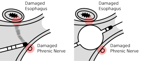 Atrial Fibrillation - AFib Symptoms and Treatments - Boston Scientific