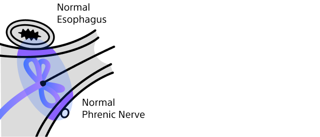 Atrial Fibrillation - AFib Symptoms and Treatments - Boston Scientific