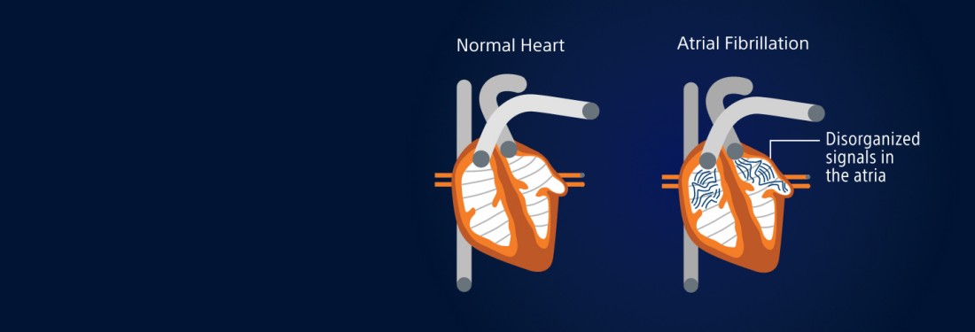 Atrial Fibrillation - AFib Symptoms and Treatments - Boston Scientific
