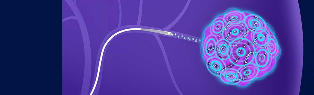 Liver Cancer Pre-Procedure - Boston Scientific