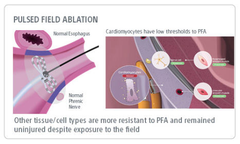 PFA Therapy - FARAPULSE™ PFA System - Boston Scientific