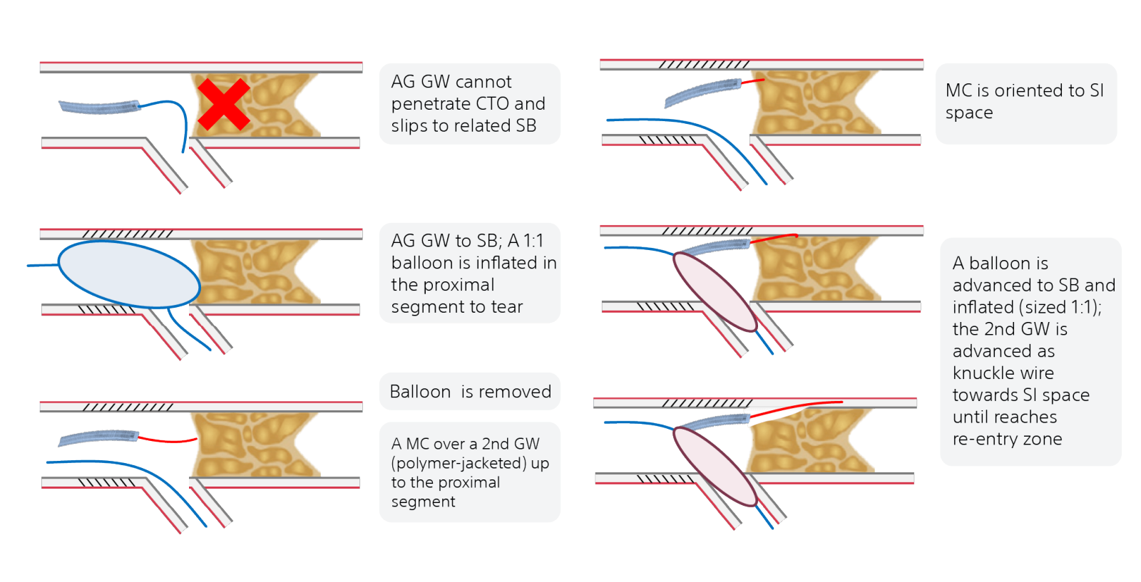 Side-Balloon assisted Sub-Intimal Entry - Boston Scientific