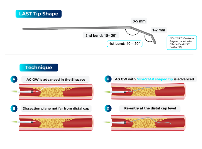 Mini Subintimal Tracking and Reentry - Boston Scientific